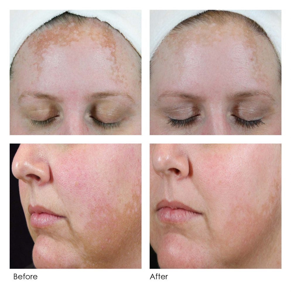 Pigment Control Kit – Mint Smilebar Online