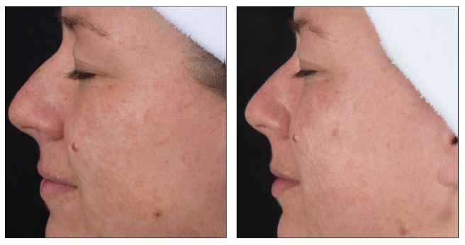 Pigment Control Kit – Mint Smilebar Online